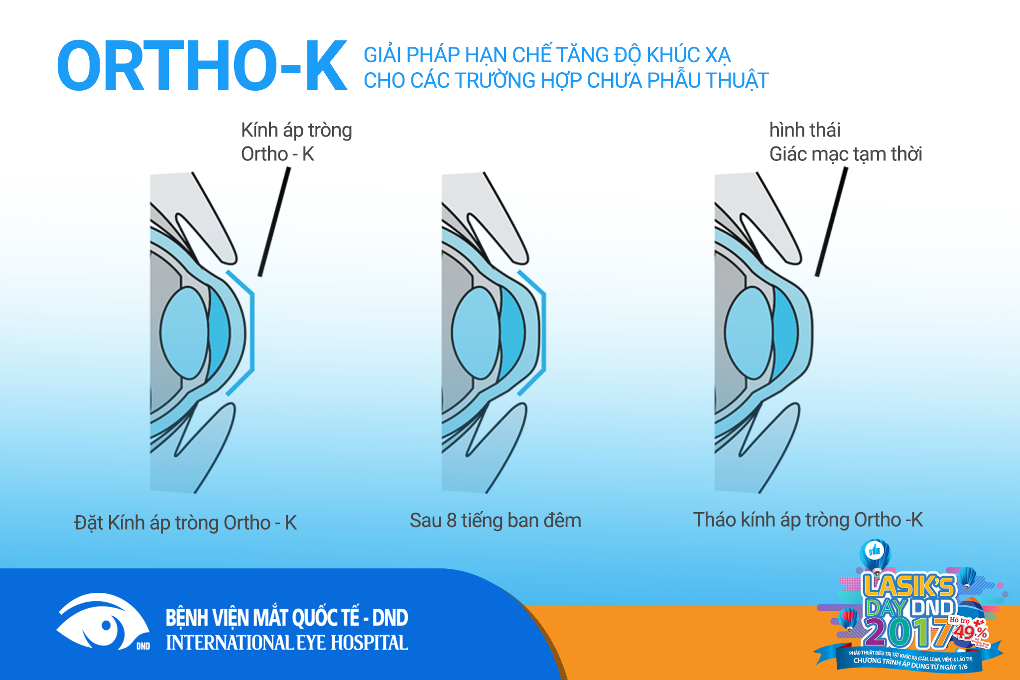 [:vi]Ortho-k: giải pháp hạn chế tăng độ khúc xạ cho các trường hợp chưa ...