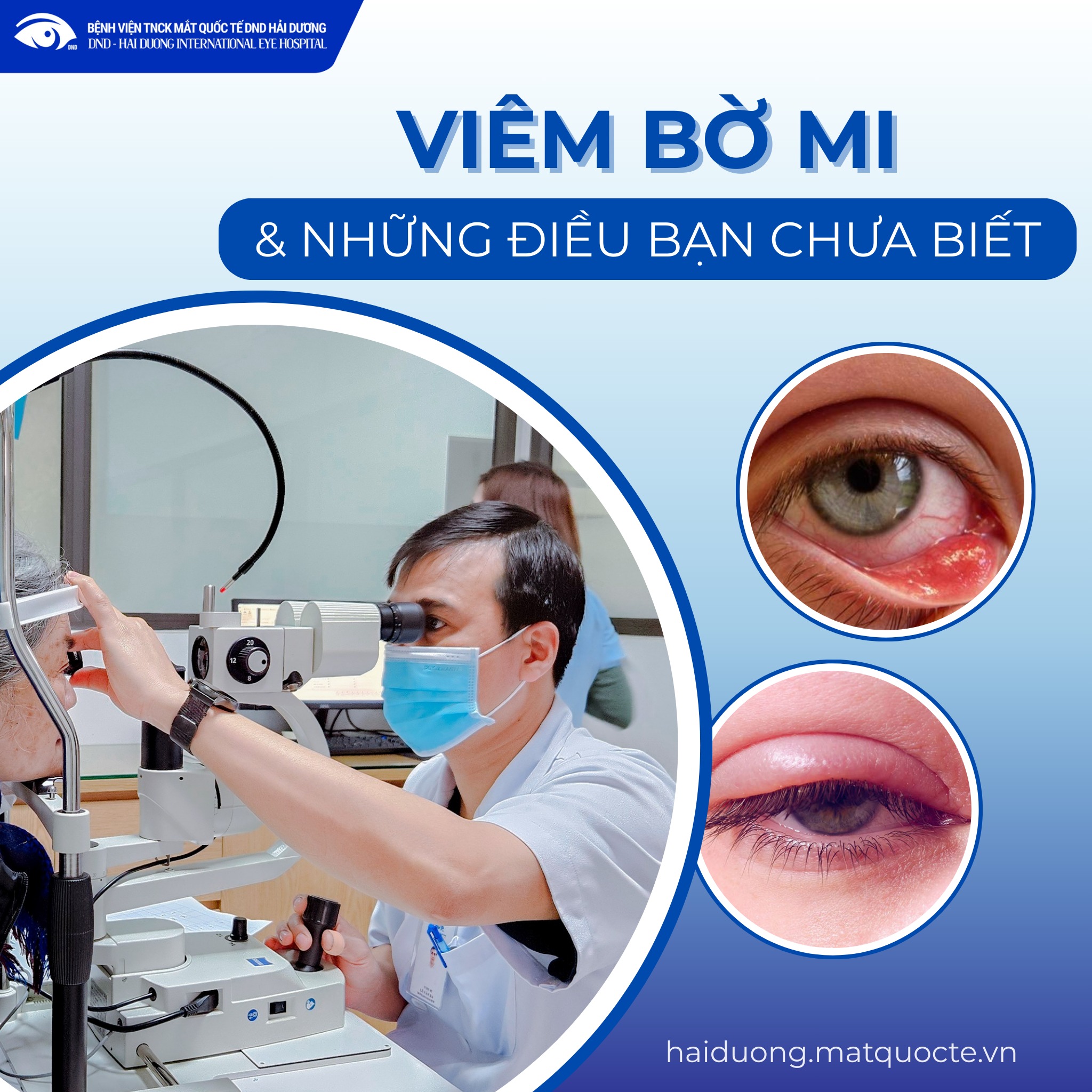 Viêm Bờ Mi: Nguyên Nhân, Triệu Chứng & Cách Phòng Tránh Hiệu Quả – Bệnh viện Mắt Quốc tế DND Hải ...